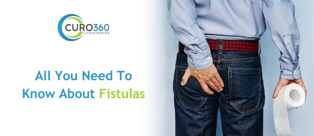 All You Need To Know About Fistulas